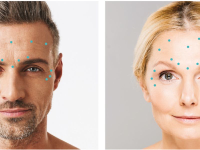 More Men Are Getting Botox Than Ever Heres How ‘brotox Is Different