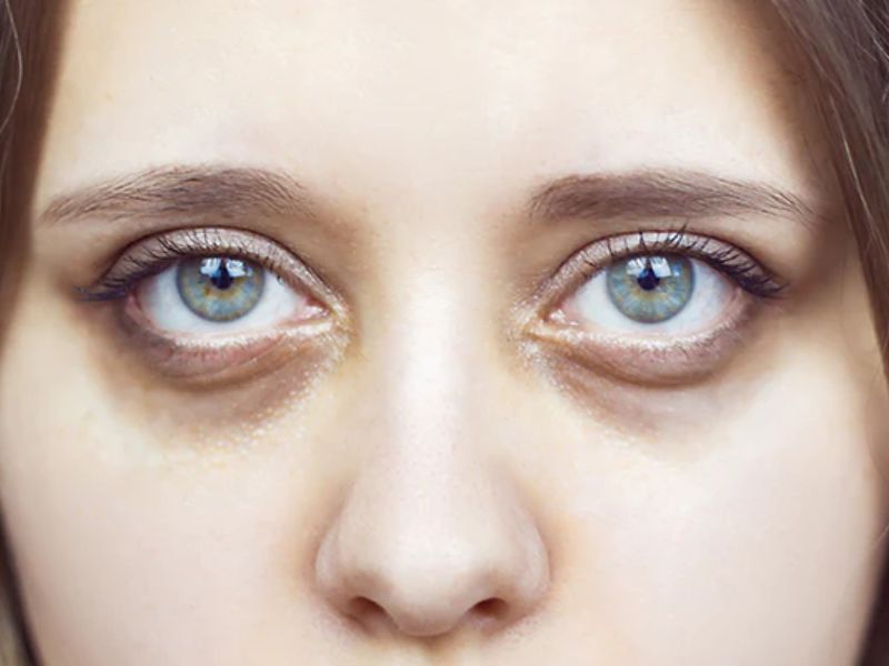 Why You Should Never Rub Your Eyes Why You Should Never Rub Your Eyes